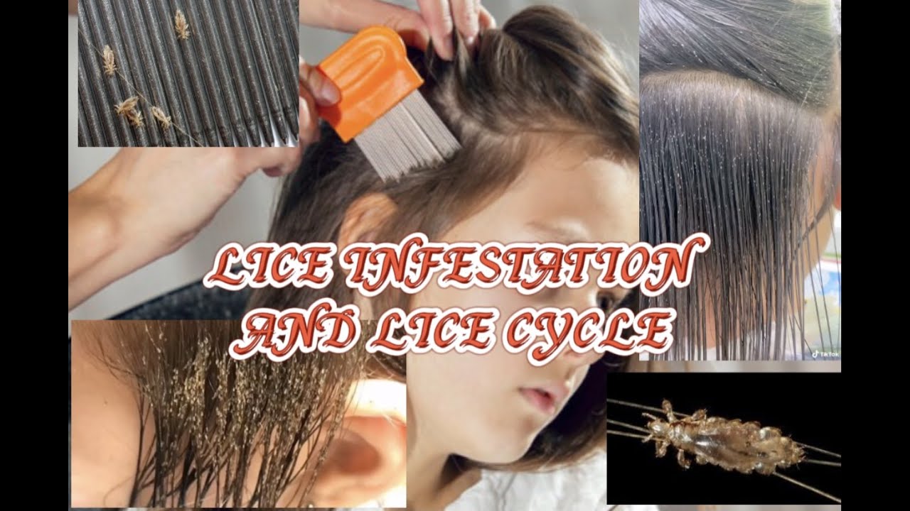 LICE INFESTATION//LICE REMOVAL//THOUSANDS OF LICE - YouTube