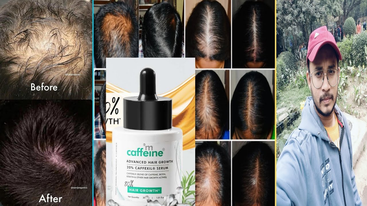 m caffeine advanced hair growth serum | honest review - YouTube