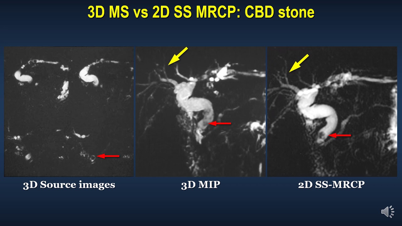 Imaging Techniques of Pancreas and Biliary MRI - YouTube