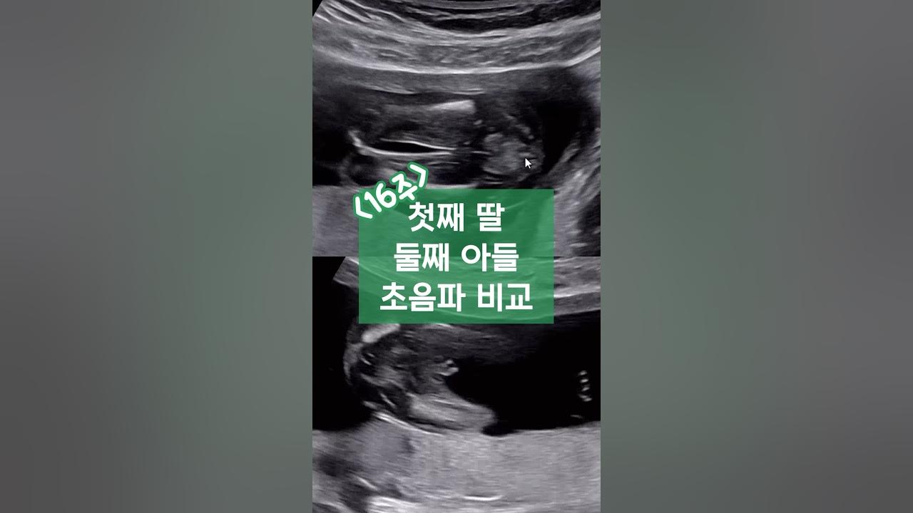 16주 초음파 딸 아들 구분하기 Youtube