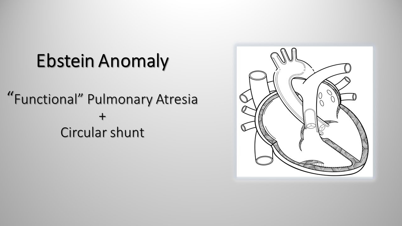 Pulmonary Atresia Anesthesia at Geri Hodge blog