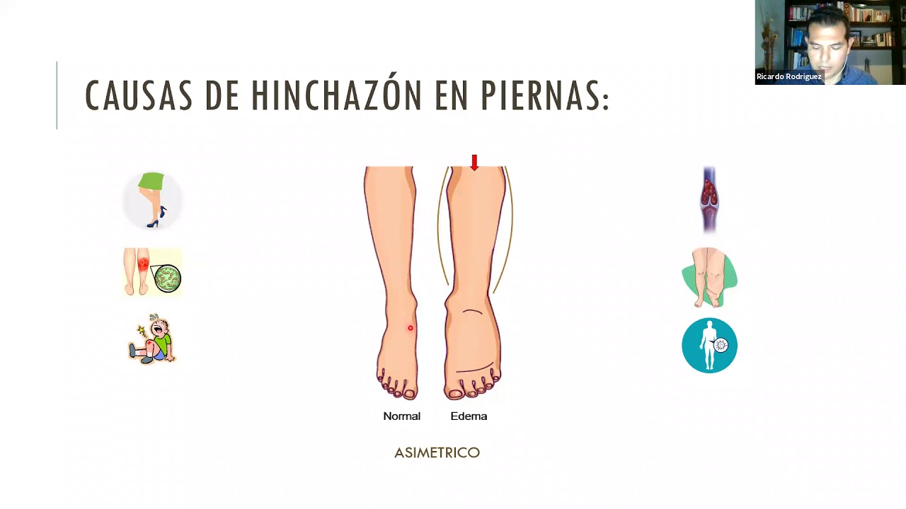 Sesion 2 ¿Porque se hinchan las piernas? - YouTube