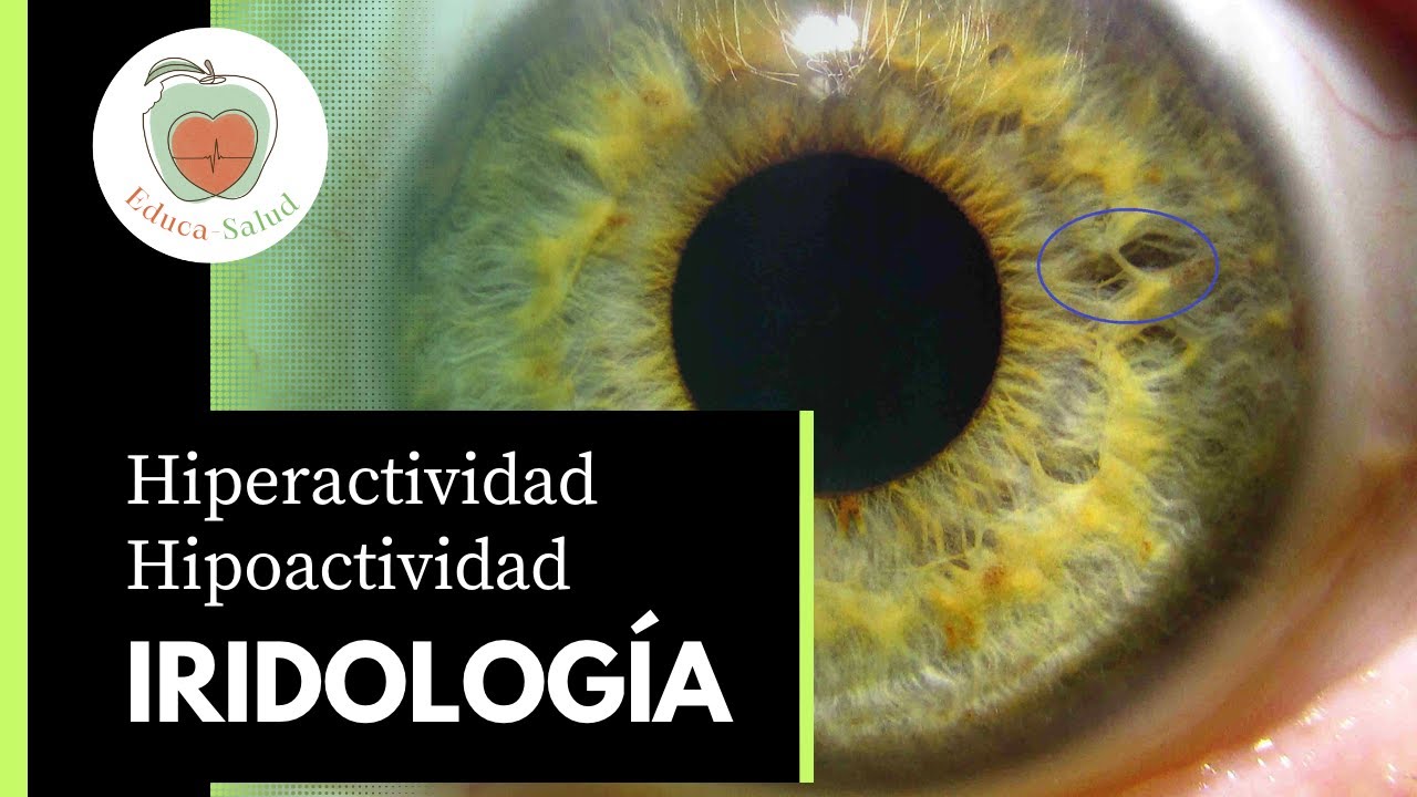 Iridología: La Enfermedad como Hiperactividad o Hipoactividad - YouTube