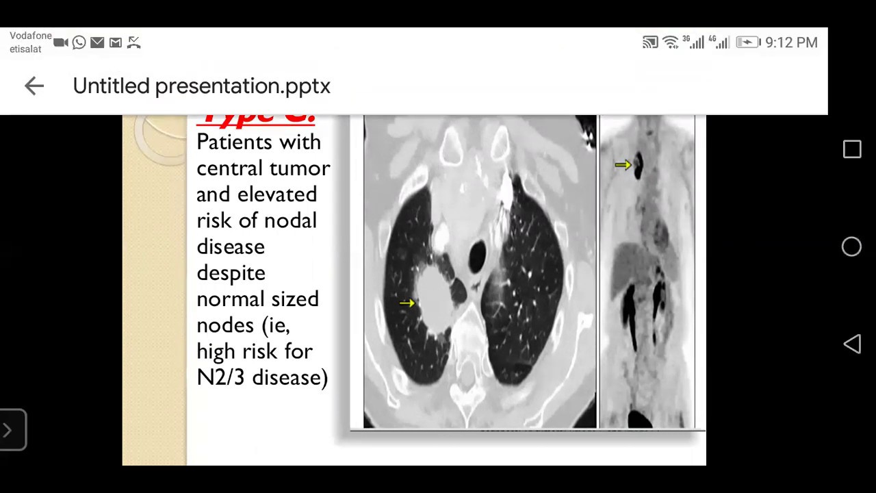 Management of Unresectable NSCLC - YouTube