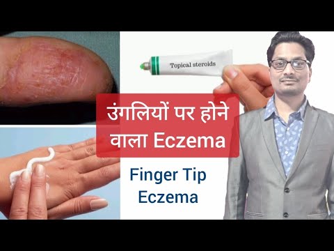 उंगलियों पर होने वाला Eczema | Finger Tip Eczema | Hand Eczema | Hand ...