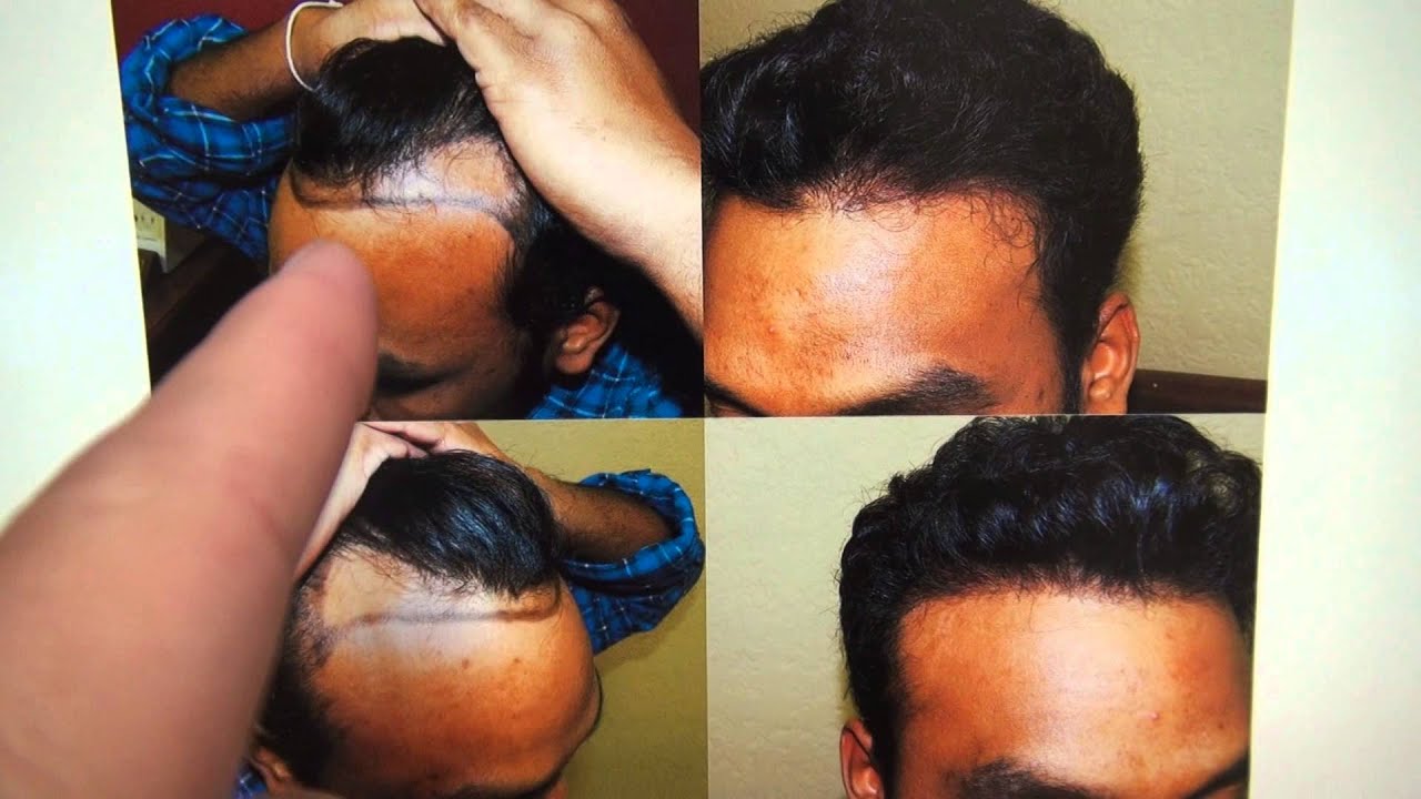 Northern California Hairline Lowering Surgery Before After Hair ...