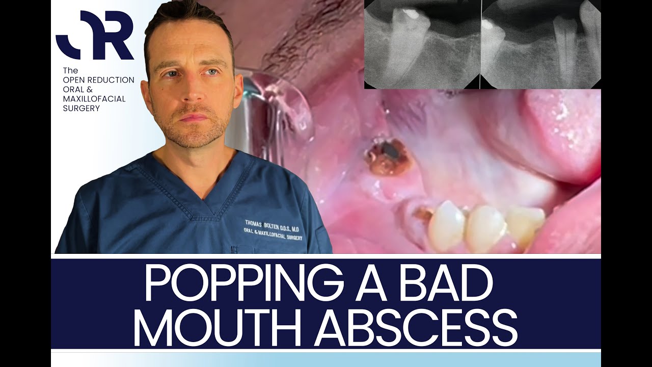 POPPING a BAD MOUTH ABSCESS - YouTube