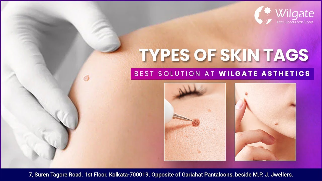 Types of Skin Tags & Safe Removal Tips by Dr. Rupak Kishore Mookerjee ...