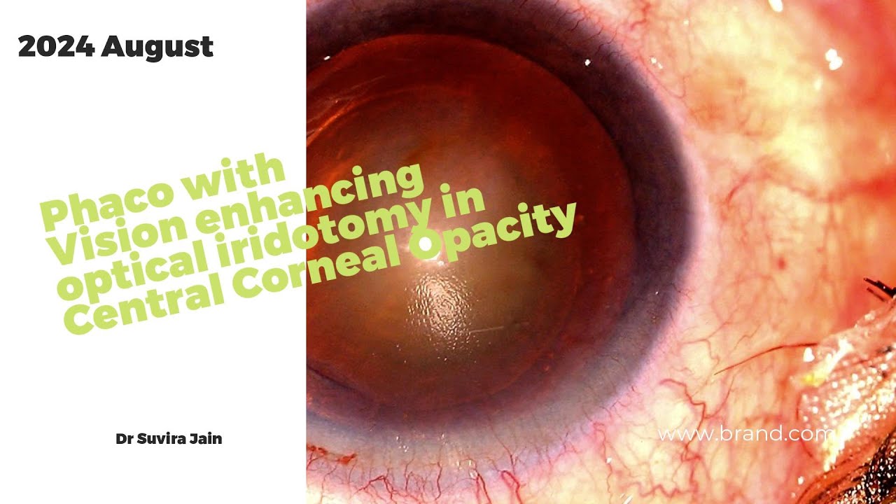 Phacoemulsification with Optical iridectomy to enhance vision is a case ...
