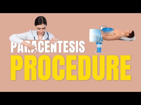 Paracentesis procedure || Paracentesis procedure full video explanation ||