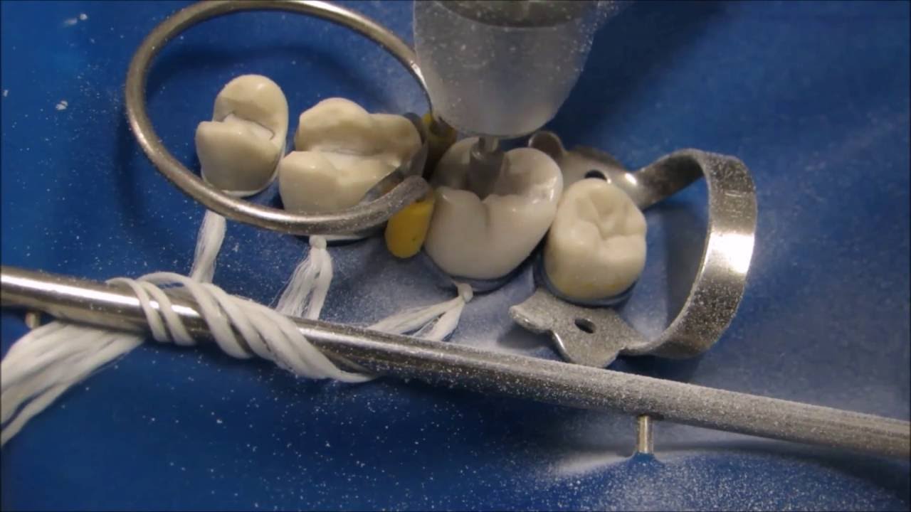 Preparo parcial Onlay - YouTube