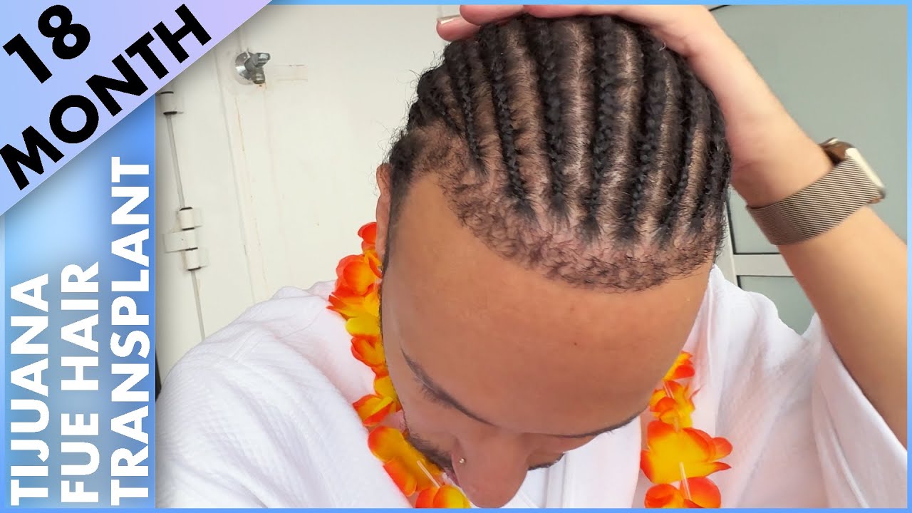 Month 18 | FUE Hair Transplant In Tijuana | Biracial Black Afro Hair ...