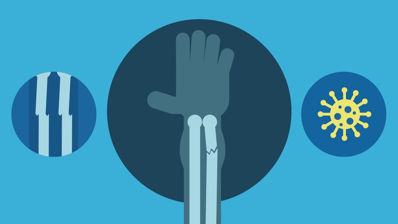 Radial Fractures - CRAFFT Study Animation - YouTube