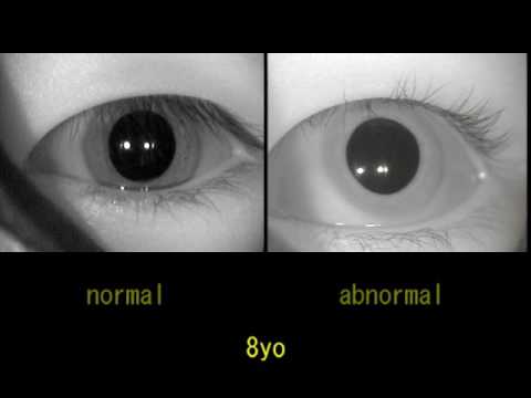 eye findings o normal and abnormal - YouTube