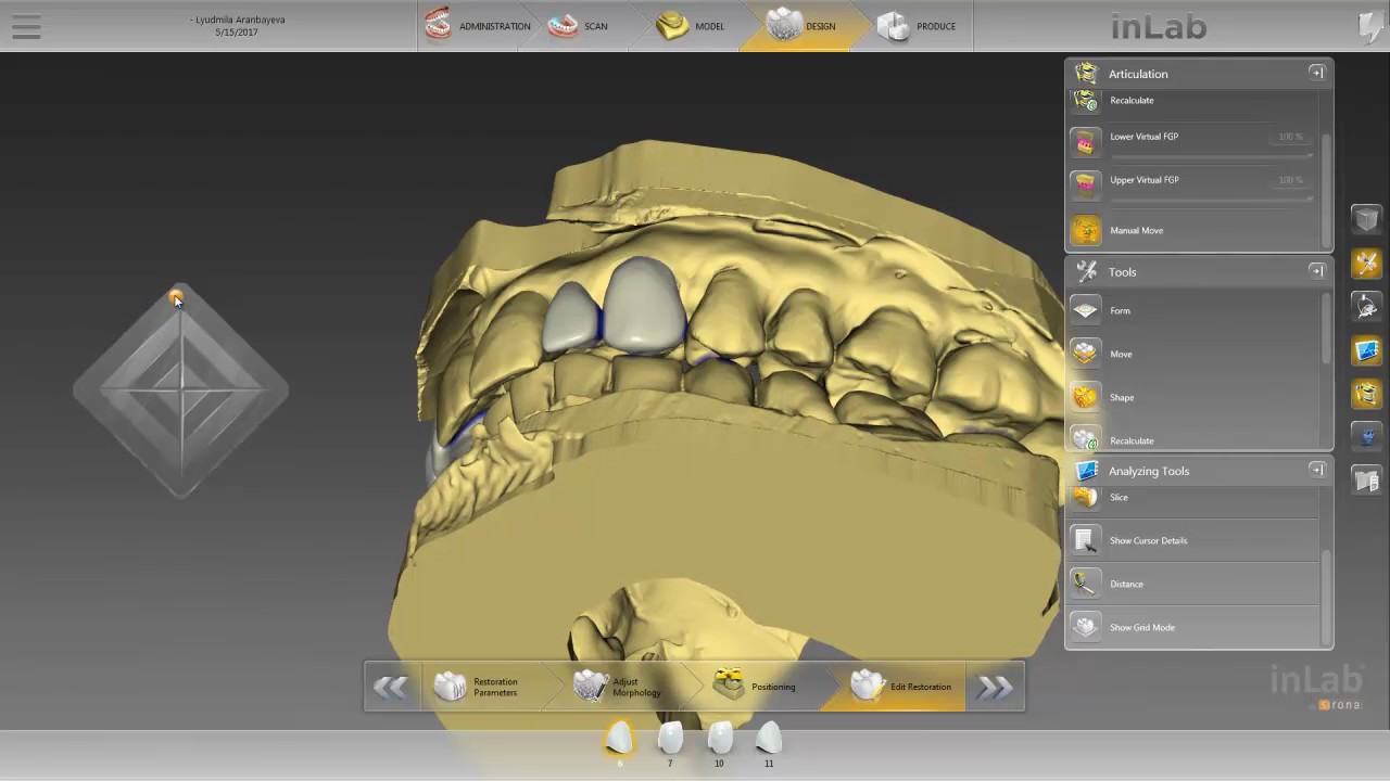 CEREC Inlab Digital Wax Up - YouTube