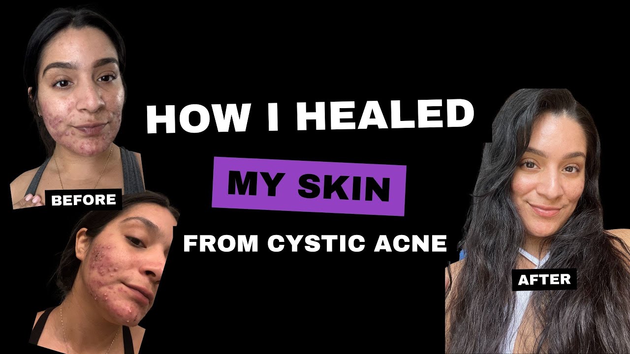 How I healed my skin from Cystic Acne - YouTube