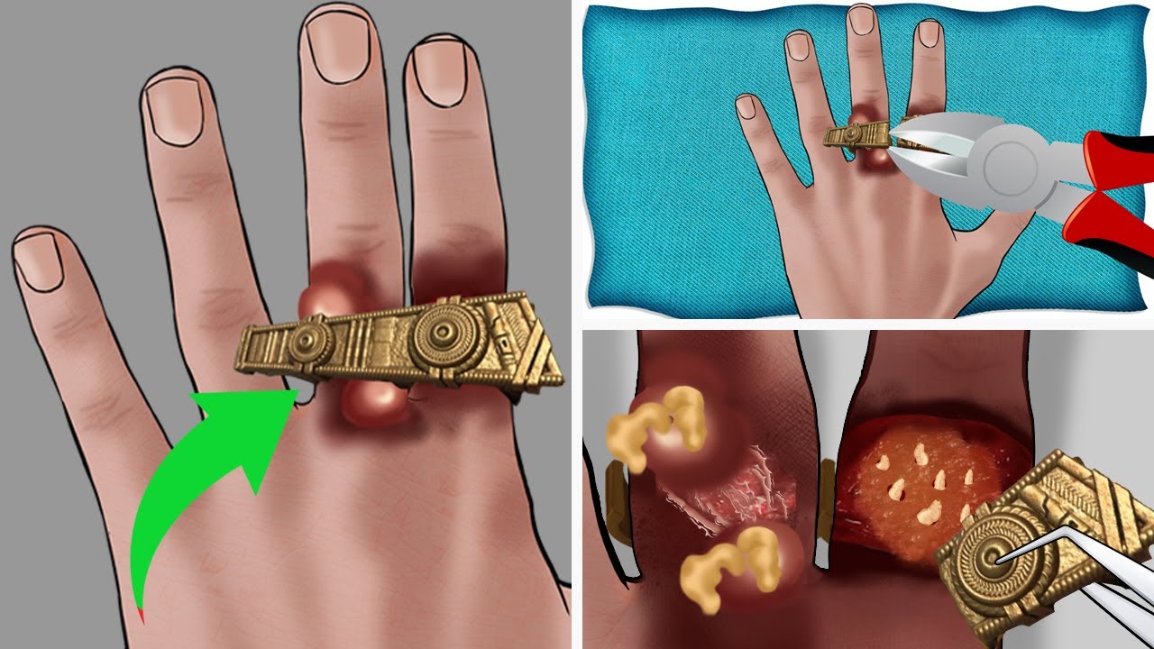 [ASMR] Treat injuries from wearing rings that are too tight - YouTube