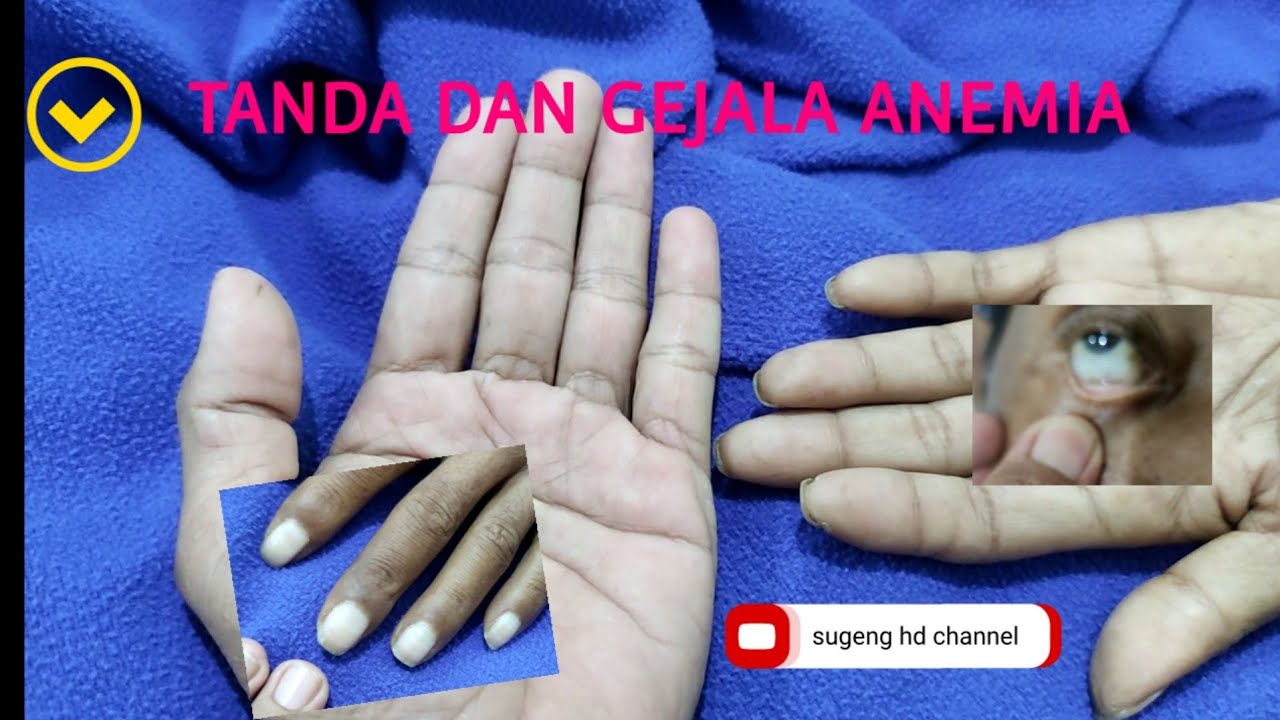 TANDA DAN GEJALA ANEMIA - YouTube