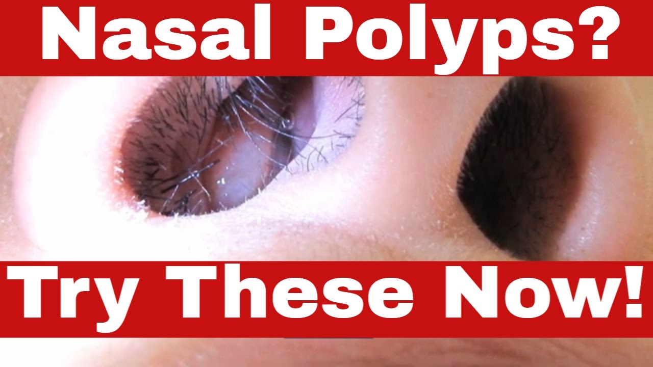How to Remove Nasal Polyps Yourself - No Surgery Needed! - YouTube