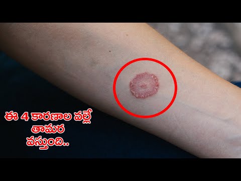 Top 4 Causes of Tinea (Thamara) | Permanent Solutions to Prevent and Cure | Inform clinics