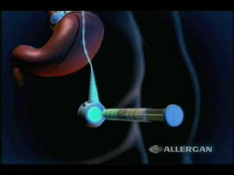 Dallas Lap-Band Surgeon Explains How the Lap-Band Works - YouTube