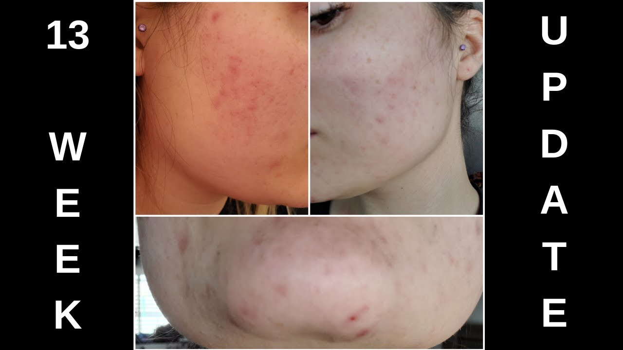 Spironolactone for Acne! 13 WEEK UPDATE! (It's working!) - Episode #11 ...