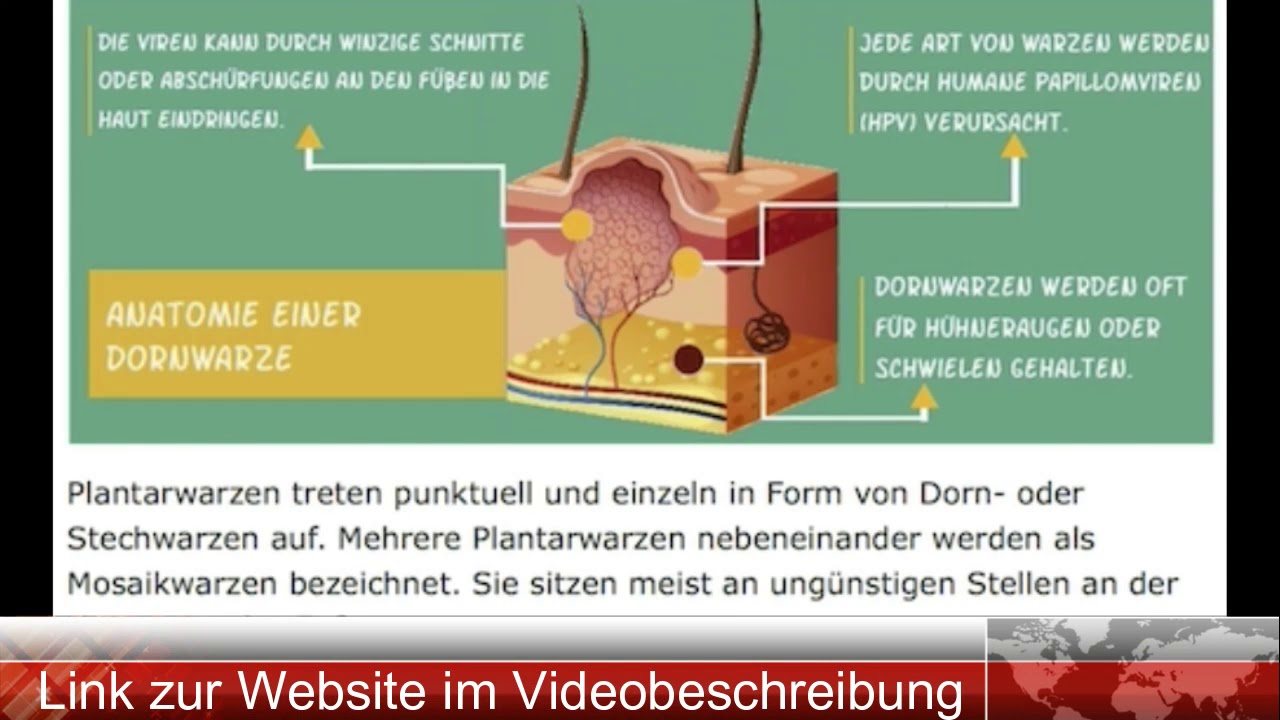 Dornwarze - Der Ratgeber - YouTube