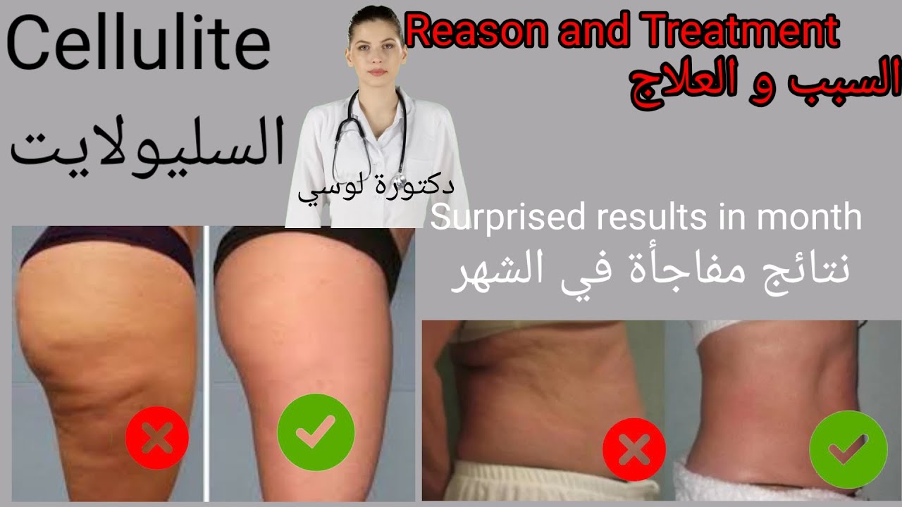Get Rid From Cellulite In One Month Only get-rid-from-cellulite-in-one-month-only