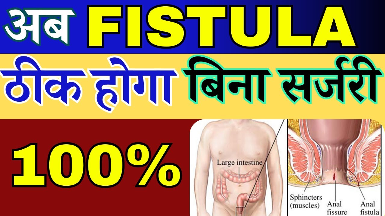 Fistula Treatment Without Surgery in India | Fistula Homeopathy ...
