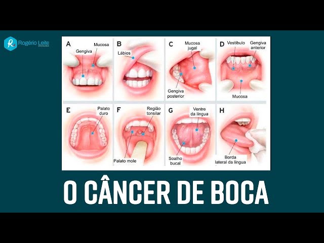 Cancer De Gengiva Precoce