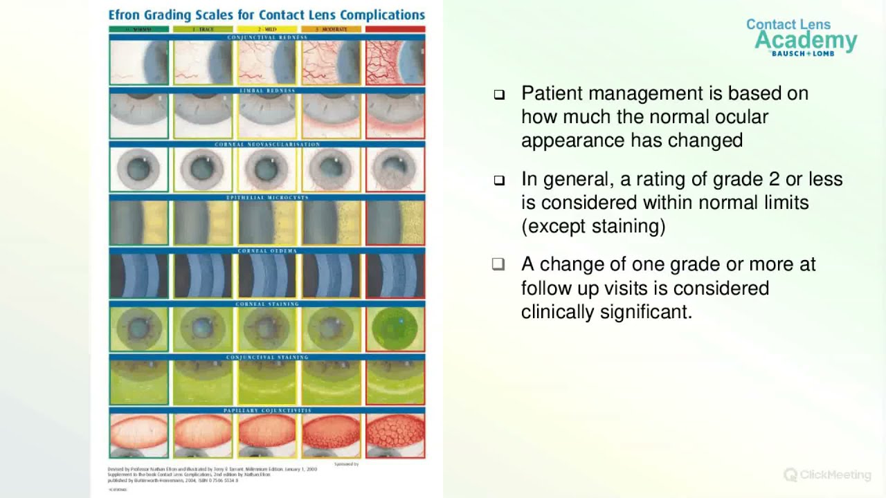 non pagato ieri indigeno efron grading scale for contact lens ...