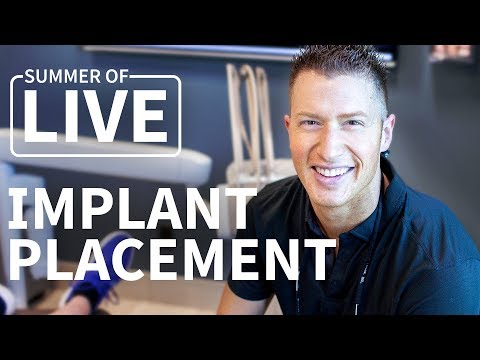Guided Dental Implant Placement - LIVE Treatment