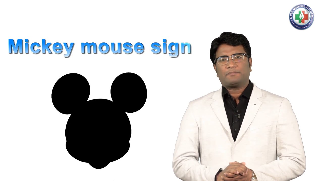 Mickey Mouse Sign Radiology By Dr Khaleel Youtube