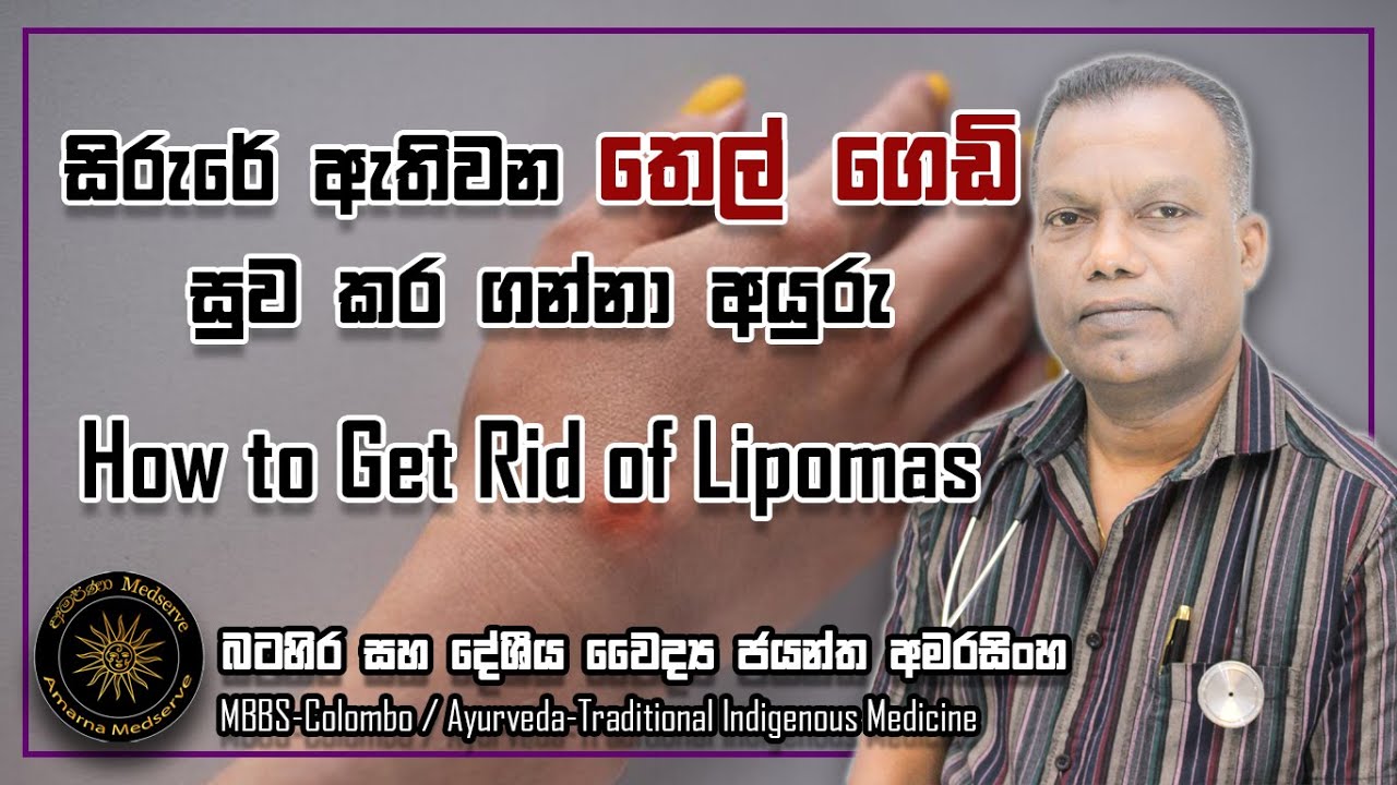 සිරුරේ ඇතිවන තෙල් ගෙඩි සුව කර ගන්නා අයුරු | How to Get Rid of Lipomas ...