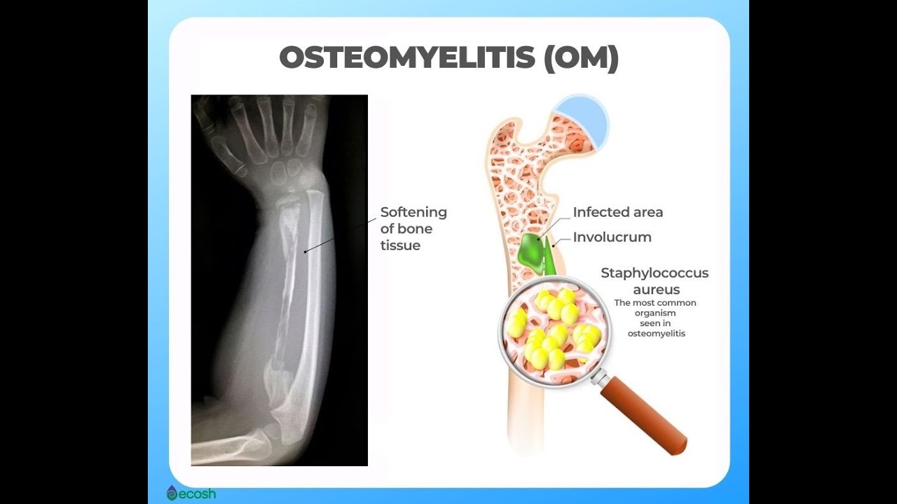 Osteomyelitis Osteomyelitis | HuffPost