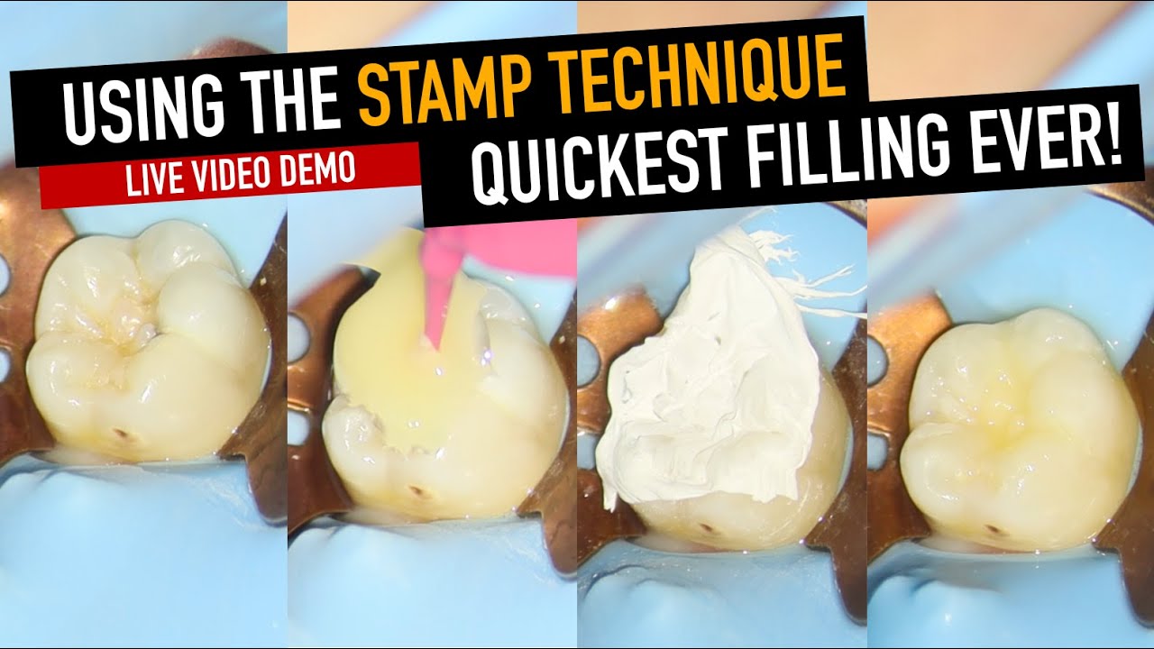 QUICKEST DENTAL FILLING - THE STAMP TECHNIQUE | 4K Resolution - YouTube