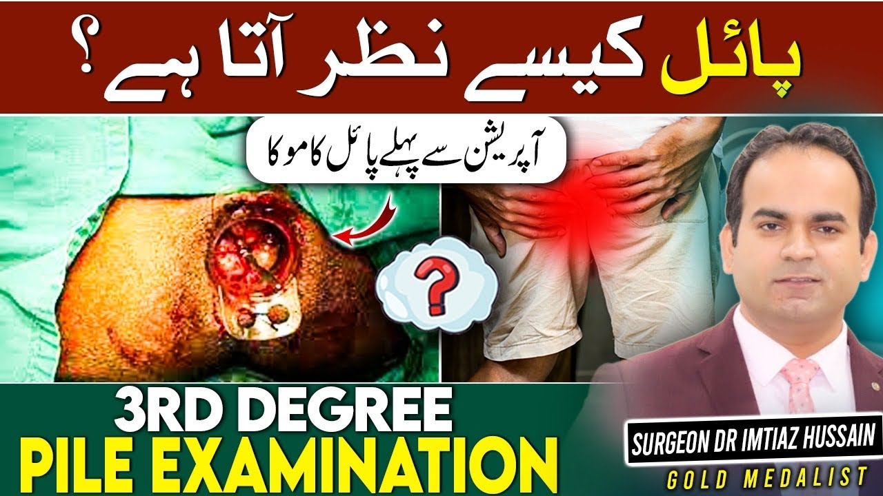 How 3rd Degree Piles Look | Examination of Haemorrhoids | Surgeon Dr ...
