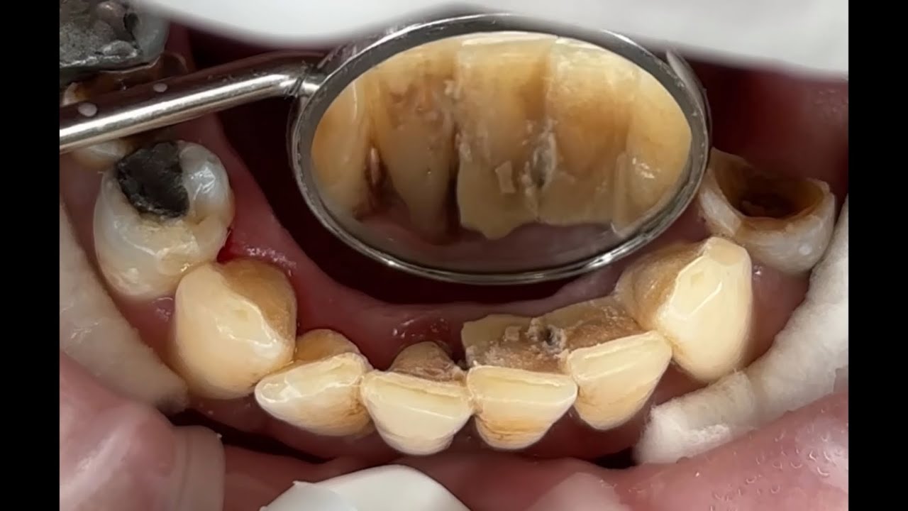 ASMR - Heavy calculus removal - YouTube