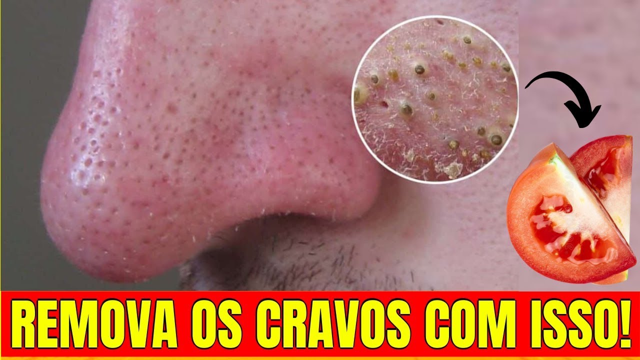 Como REMOVER os CRAVOS FACILMENTE com essa RECEITA CASEIRA - YouTube