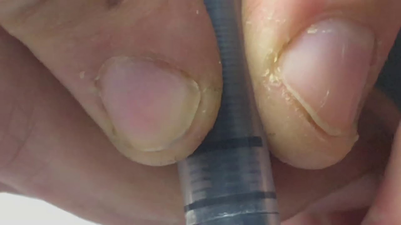 Clasp For posterior teeth / RPD / Prosthodontic - YouTube
