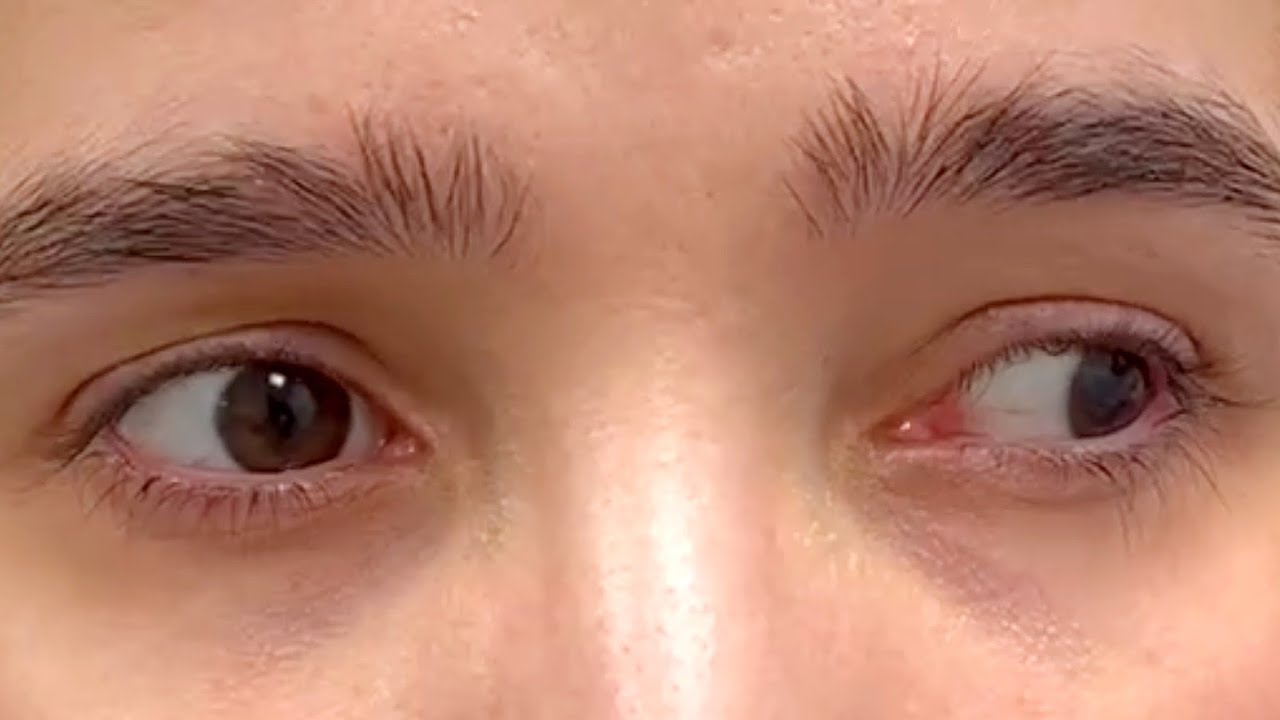 EYE Paralysis? - Internuclear ophthalmoplegia | Causes, Symptoms ...