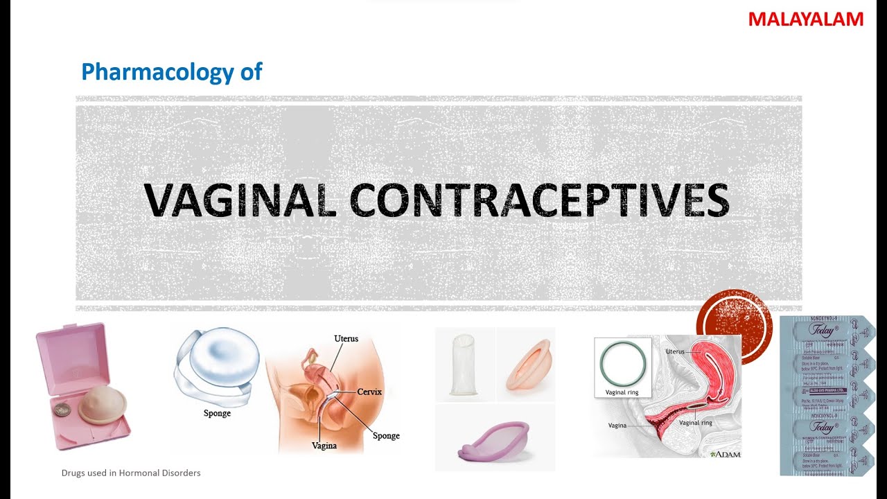 VAGINAL CONTRACEPTIVES: Sponge, Diaphragm, cervical cap, cervical ...