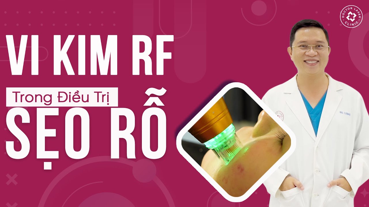 🍀Vi kim RF trong điều trị sẹo rỗ | Các phương pháp điều trị sẹo rỗ tại ...