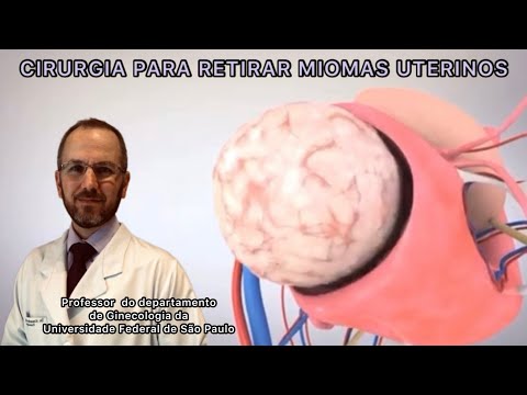 MIOMECTOMIA - CIRURGIA PARA RETIRAR MIOMAS DO ÚTERO - YouTube