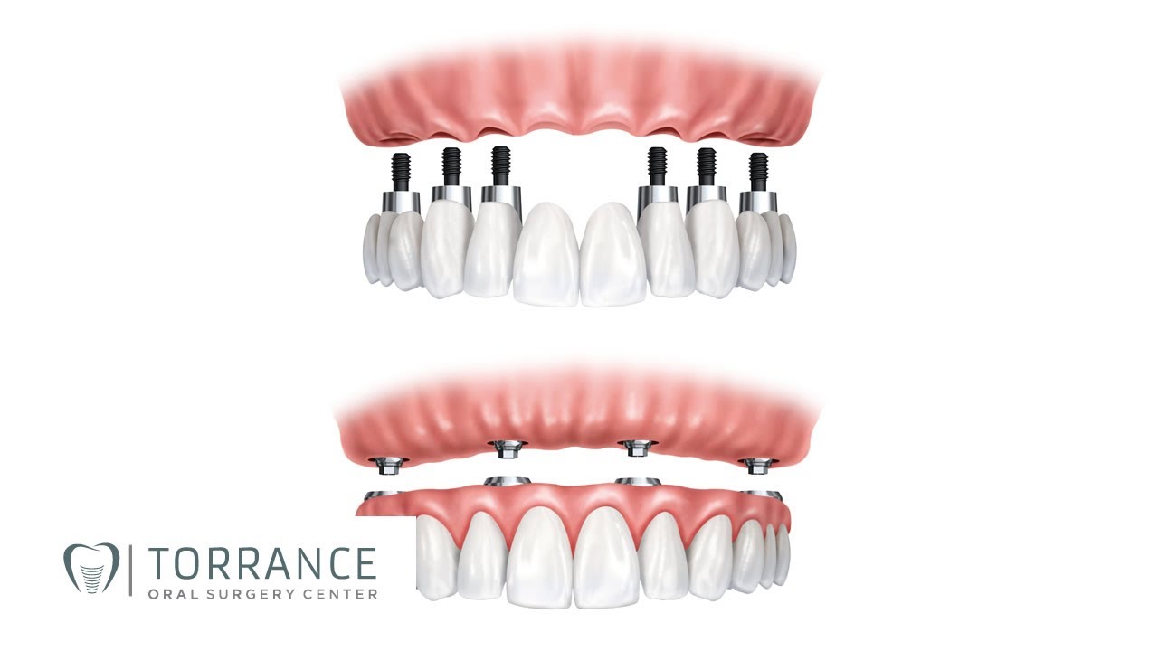 Torrance Implant Retained Hybrid Denture | Redondo Beach Implant ...