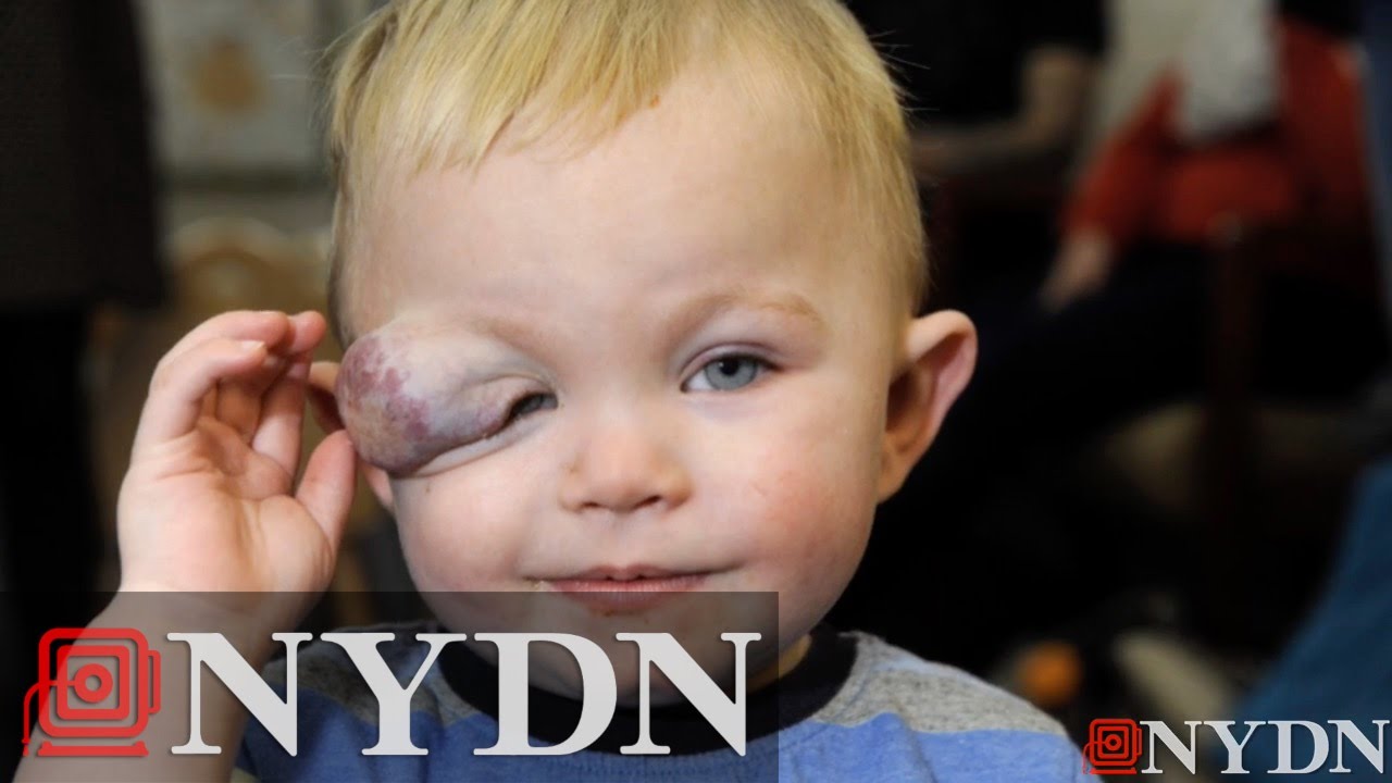 17-month-old's birthmark turns into tumor over eye - YouTube