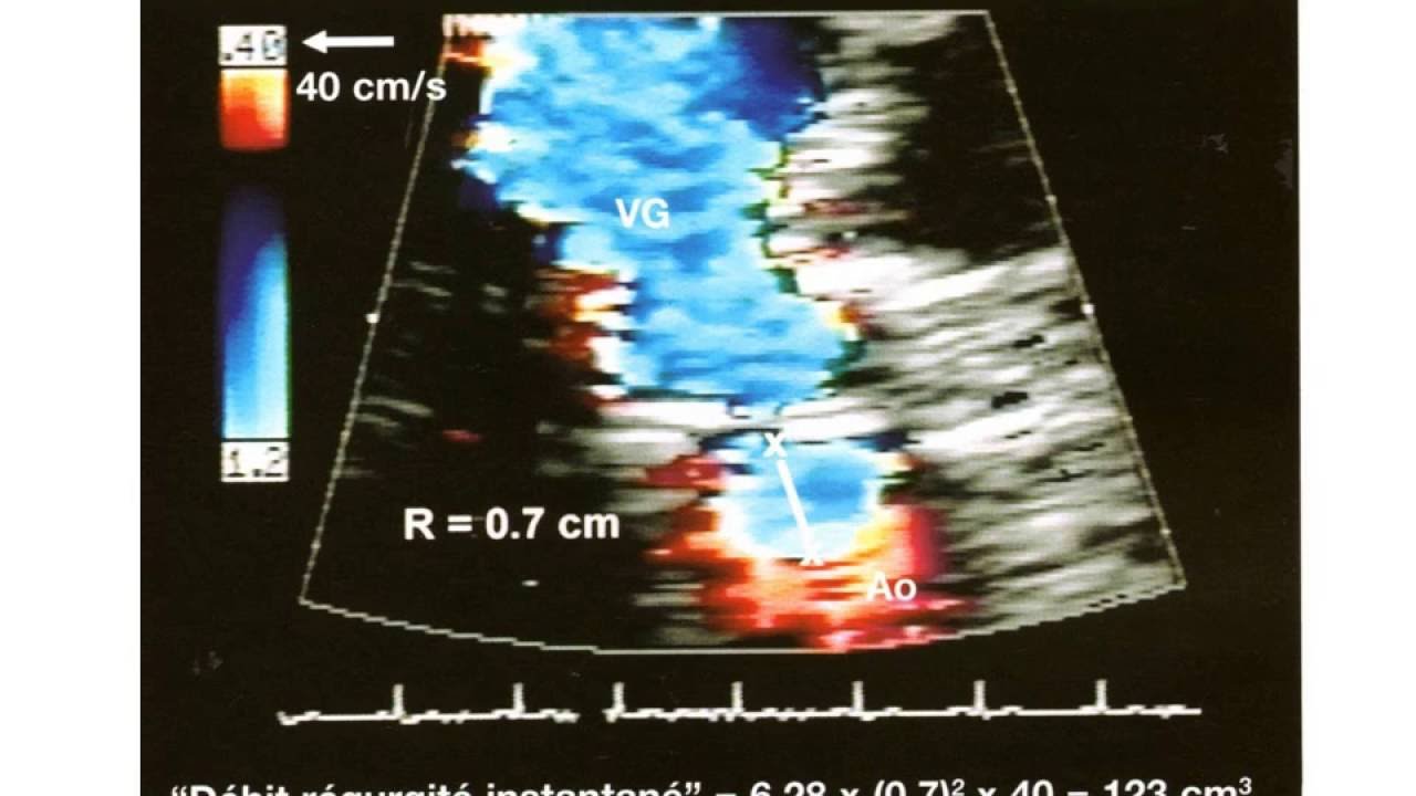 CARDIOLOGIE INSUFFISANCE AORTIQUE - YouTube