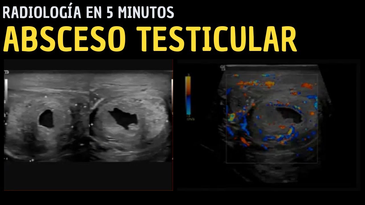 Radiología en 5 minutos: Absceso testicular. - YouTube