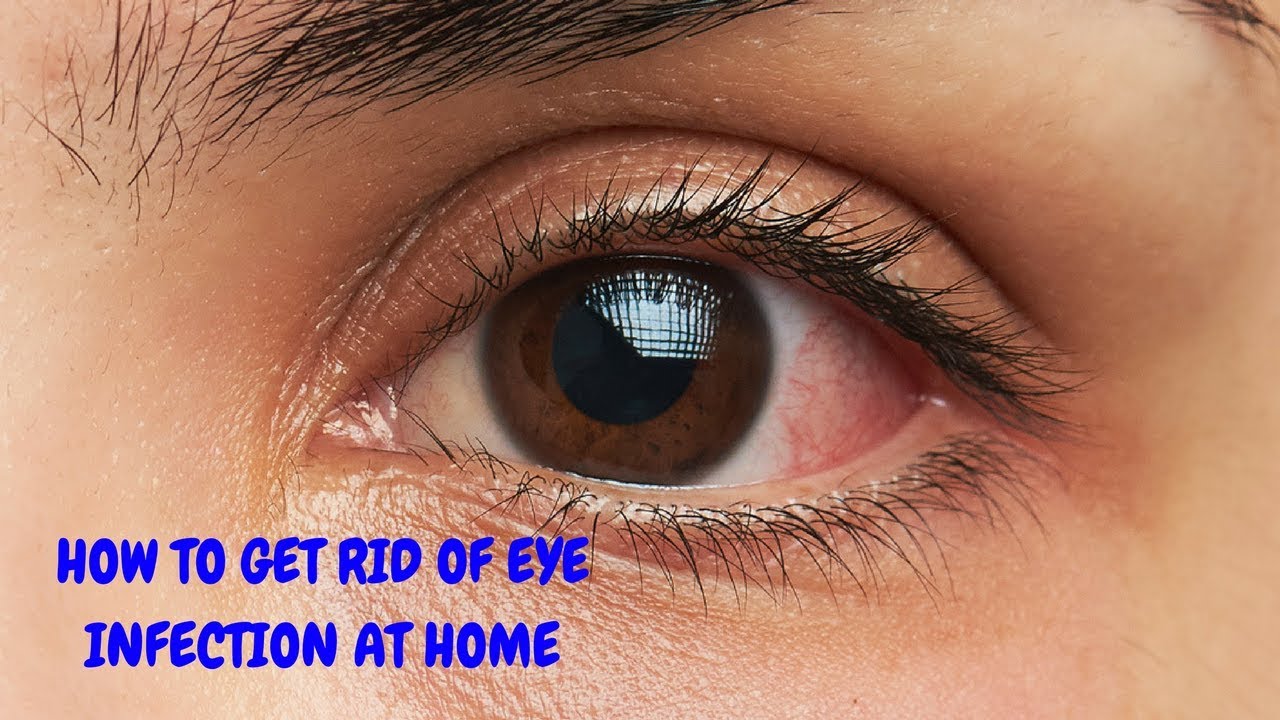 HOW TO GET RID OF EYE INFECTION AT HOME - YouTube