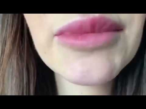 Voice Feminization Surgery, Voice Lifting Surgery - YouTube